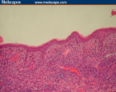 Papulosquamous Eruption of the Trunk and Extremities