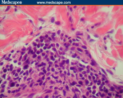 Papulosquamous Eruption of the Trunk and Extremities