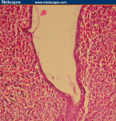 Adenosarcoma of the Uterus: A Case Report - Page 3