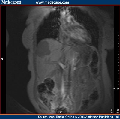 Incidental liver mass on MRI -- 12/15/2003