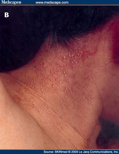 Paracetamol-Induced Acute Generalized Exanthematous Pustulosis