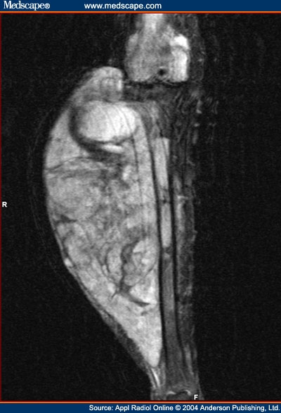 Right Leg Pain After Recent Fall