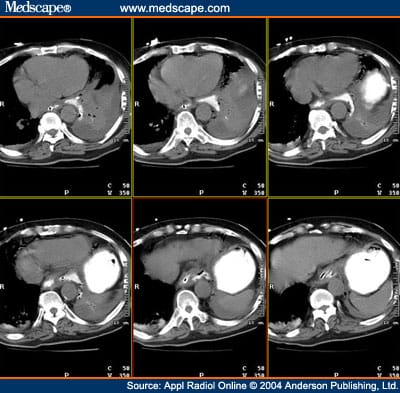 87 Year Old With Crepitus
