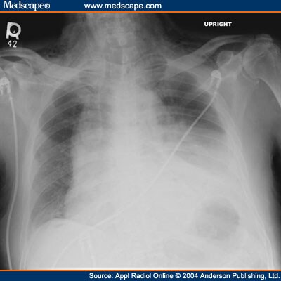 87 Year Old With Crepitus