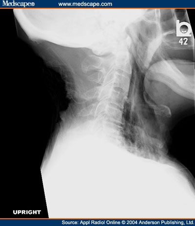 87 Year Old With Crepitus