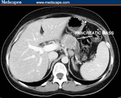 A 42-Year-Old Cushingoid Man With a Bleeding Duodenal Ulcer