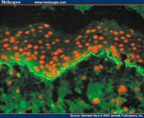 Treating Immunobullous Diseases: An Update