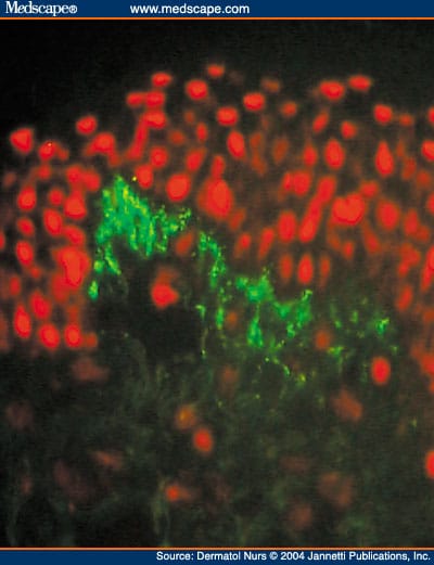 Treating Immunobullous Diseases: An Update
