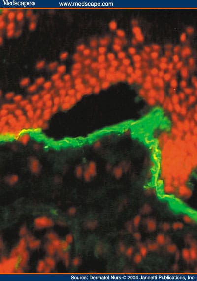 Treating Immunobullous Diseases: An Update