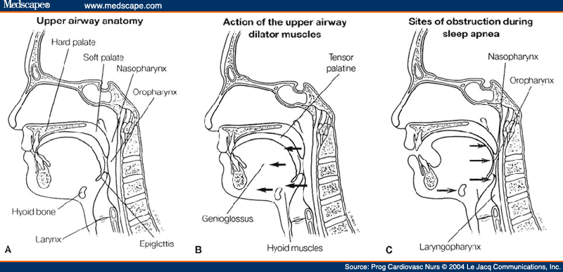 Sleep-Disordered Breathing and the Association With Cardiovascul - Page 3