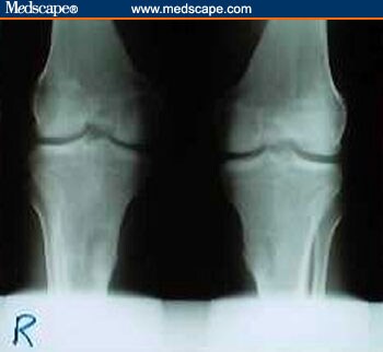 Nail-Patella Syndrome in Saudi Arabia - Page 3