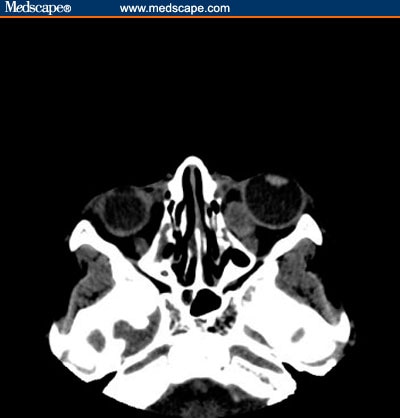 A Child With Acute Unilateral Proptosis