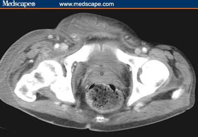 58-Year-Old Man With a Groin Mass and Septic Shock