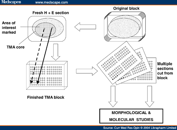 Tissue Microarrays: A Current Medical Research Tool