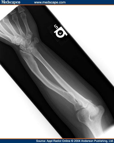 31 Year Old Female With Forearm Deformity