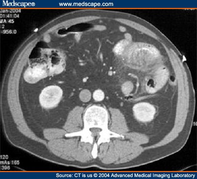 What Perforated This Bowel?