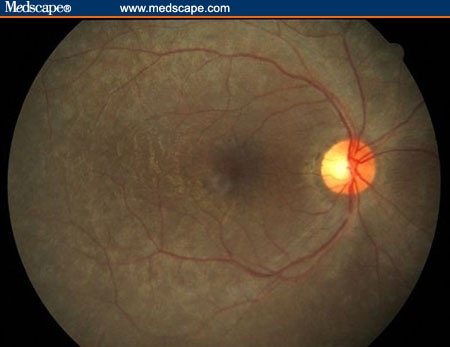 A Retinal Disease With Systemic Associations