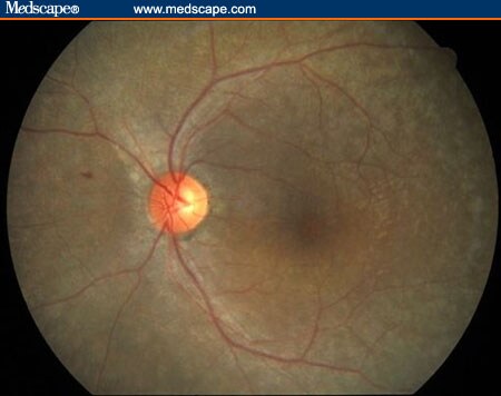 A Retinal Disease With Systemic Associations
