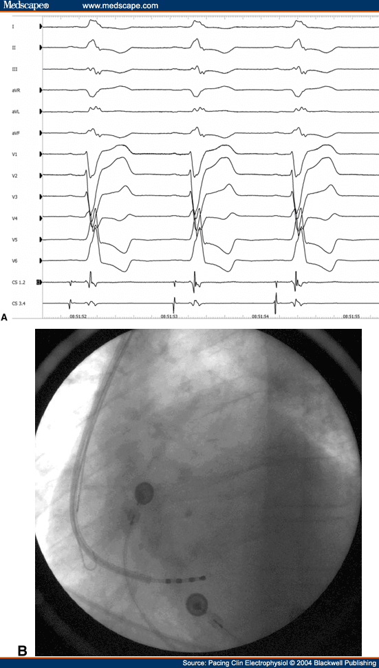 Cardiac Resynchronization Therapy in Chronic Heart Failure - Page 2
