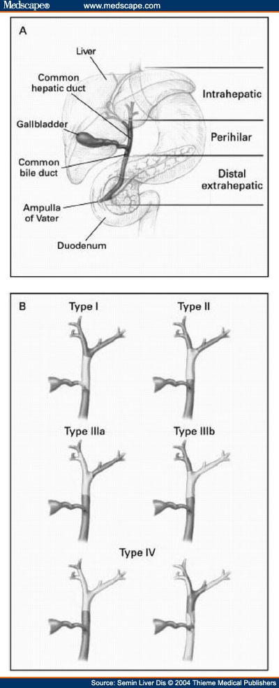Endoscopic Management of Cholangiocarcinoma