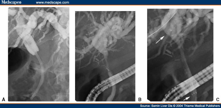 Endoscopic Management of Cholangiocarcinoma - Page 4