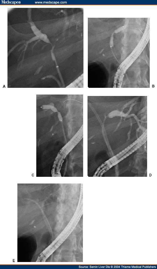 Endoscopic Management of Cholangiocarcinoma - Page 4