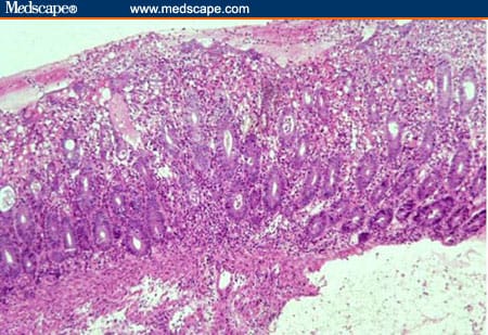 Crohn's Disease and Infections: A Complex Relationship - Page 2