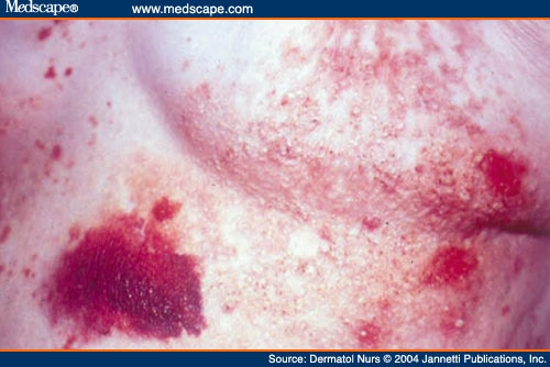 Managing the Patient with Amyloidosis - Page 6