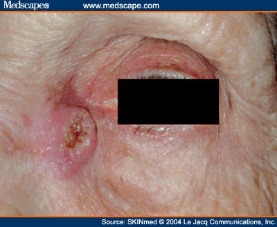 A Primer of Mohs Micrographic Surgery: Common Indications - Page 5