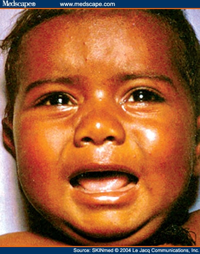 Small Pox: What the Dermatologist Should Know - Page 3