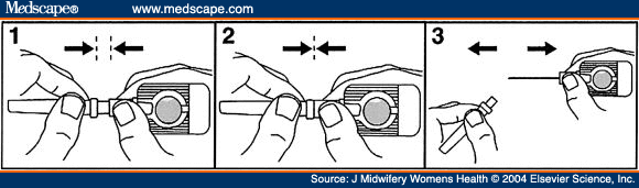Postpartum Hemorrhage: New Advances for Low-Resource Settings - Page 5
