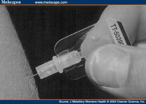 Postpartum Hemorrhage: New Advances for Low-Resource Settings - Page 5