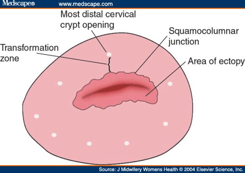 Cervical Cancer Screening in Low Resource Settings - Page 5