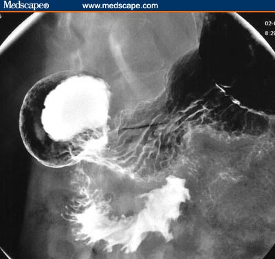 Symptoms of Gastric Outlet Obstruction in a 48-Year-Old Woman