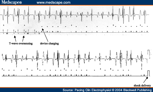 High Incidence of Appropriate and Inappropriate ICD Therapies - Page 2