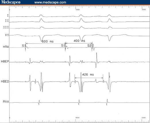 Electrophysiology Lab Consult Case 4