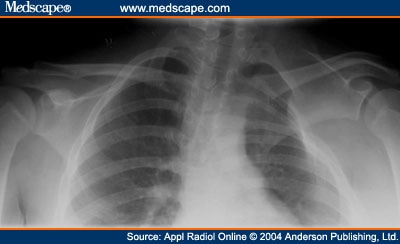 Decreased Shoulder Range of Motion