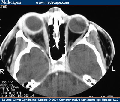 Headache and the Eye - Page 6