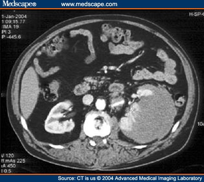 Choices for Flank Pain
