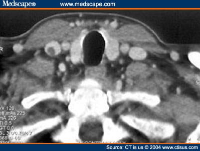 Carotid Stenosis or Abscess?