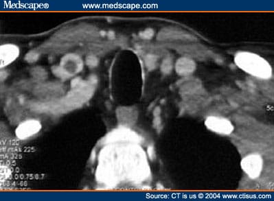 Carotid Stenosis or Abscess?