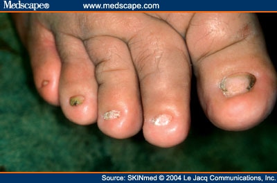 Klinefelter's Syndrome Presenting With Skin Ulcers