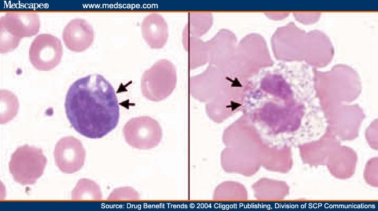 Ehrlichiosis and Anaplasmosis