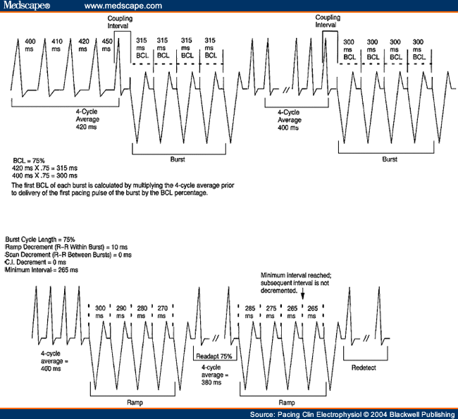 Antitachycardia Pacing for Ventricular Tachycardia - Page 6