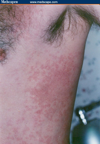 A Recent Exposure to Mustard Gas in the United States - Page 3