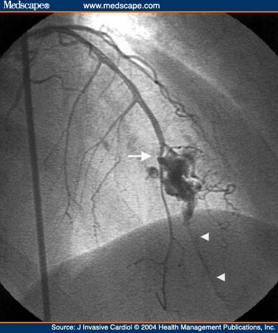 Coronary Artery Dissection and Perforation