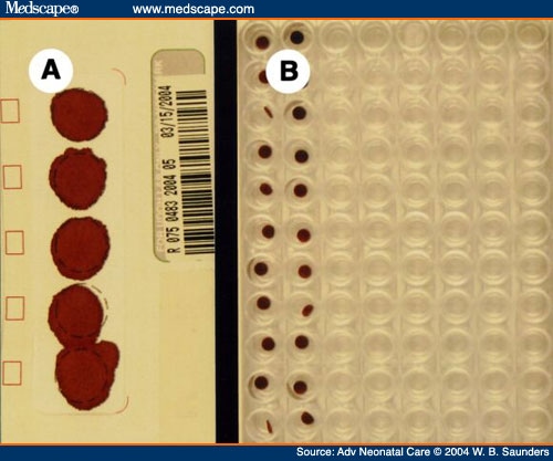 A Primer on Newborn Screening - Page 5