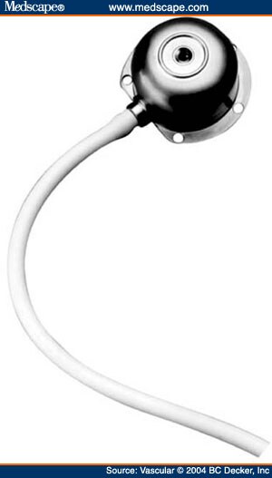 Totally Subcutaneous Hemodialysis Access: Experience with the - Page 2