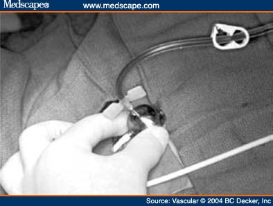 Totally Subcutaneous Hemodialysis Access: Experience with the - Page 3