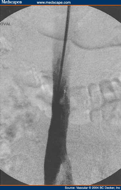 Early Technical and Clinical Results with Retrievable Inferior - Page 2